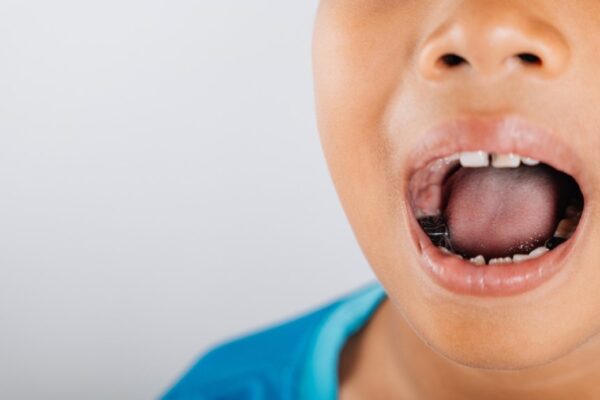 Why Do Kids Get Silver Teeth? | Super Dentists