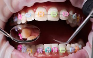 What Do Rubber Bands Do for Braces? | The Super Dentists